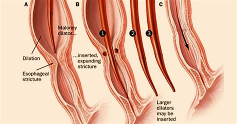 Stricture Esophageal Dilation By Vishwa Gastro And Liver Clinic
