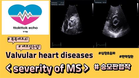 승모판협착 중증도 평가 Mitral Stenosis Severity Echocardiography 심장초음파 Heart