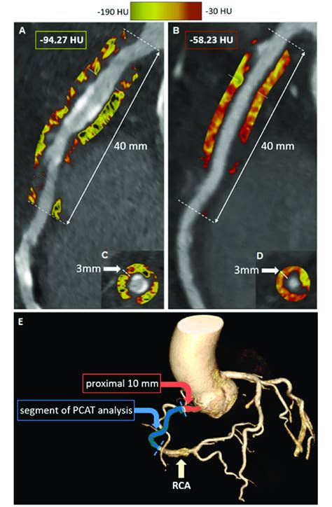 Examples Of Semi Automated Analysis Of Cta Derived Pcat Attenuation