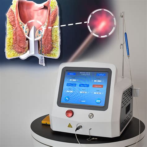 Hemorrhoidectomy Laser Surgery 1470nm 980nm Hemorrhoids Laser Treatment
