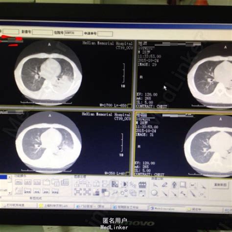 肺结核1例 医联