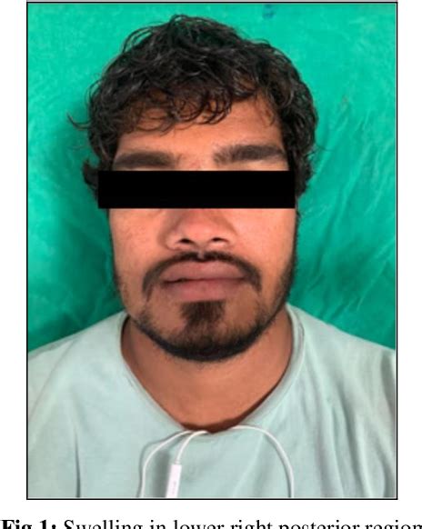 Figure 1 From Recurrent Ameloblastoma Of Mandible A Case Report