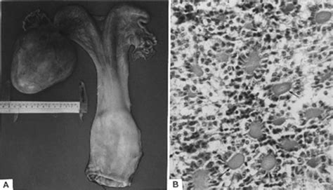 Granulosa Cell Tumor A Gross Appearance Of Tumor Mass On The Left