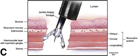 Evaluation Of Endoscopic Approaches For Deep Gastric Muscle Wall