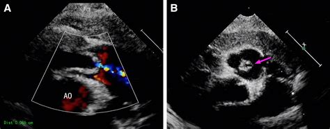 Pulmonary Valve Stenosis Echo