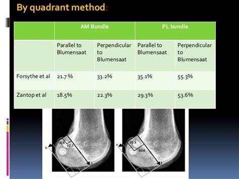 Evolution Of Tunnel Placement In Acl Reconstruction