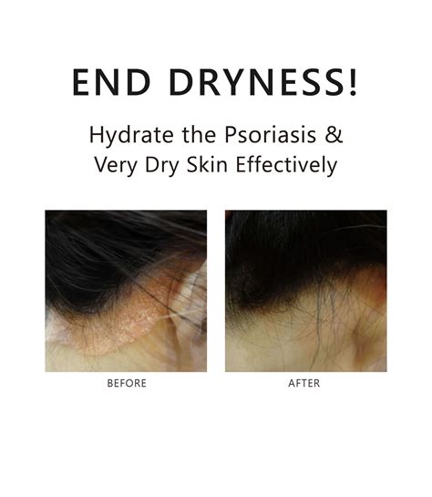 Dry Scalp Patches
