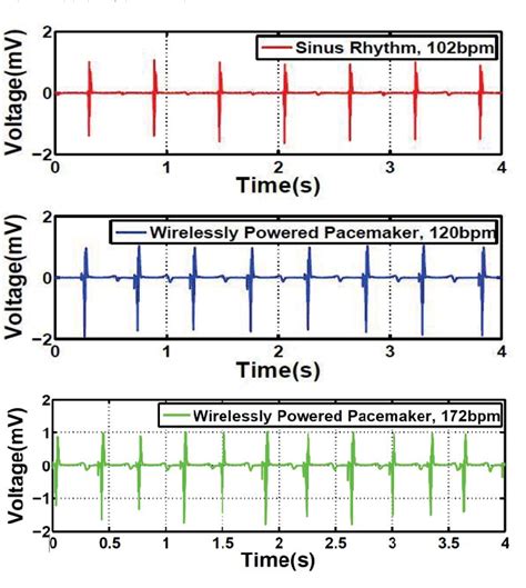 Figure 3 From Wirelessly Powered Implantable Pacemaker With On Chip