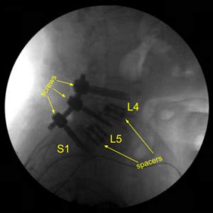 L4 To S1 Transforaminal Lumbar Fusion Complete Orthopedics