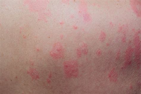 Close Up Allergy Rash Around Back View Of Human With Dermatitis