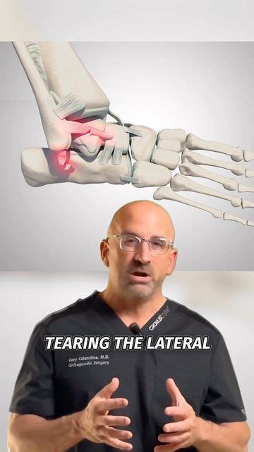 Cory Calendine Md On Instagram Lateral Ankle Sprain Las Is The Most