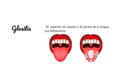 Glositis Causas Síntomas Tratamientos Y Prevención Fujwm