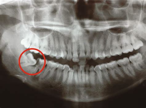What Is A Wisdom Tooth Eruption At Pam Calhoun Blog