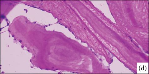 Gross Specimens Of The Resected Subaortic Membrane A And Mass B Download Scientific Diagram