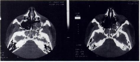Sinus Ct Showing A Fracture And Hematoma Of The Left Maxillary Sinus