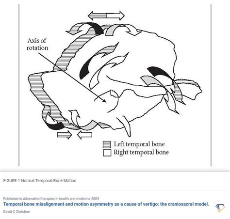 In Order To Improve The Misalignment Of The Upper Jaw Drjinhaeng Lee