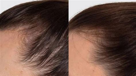 Hair Thinning Vs Balding How To Tell The Difference Rootmd