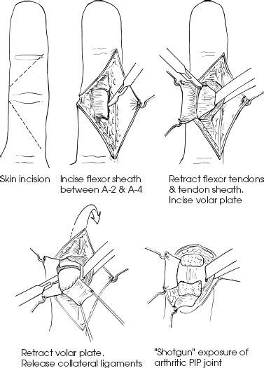 Osteoarthrits Proximal Interphalangeal Joint Silastic Implants