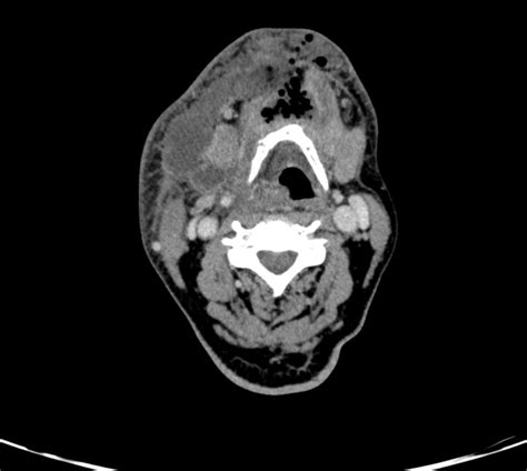 Ludwigs Angina Radiology