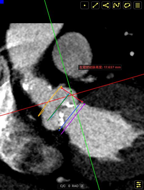 全球首例！厦心王焱教授团队成功完成原创球扩式干瓣经导管主动脉瓣置换手术 严道医声网