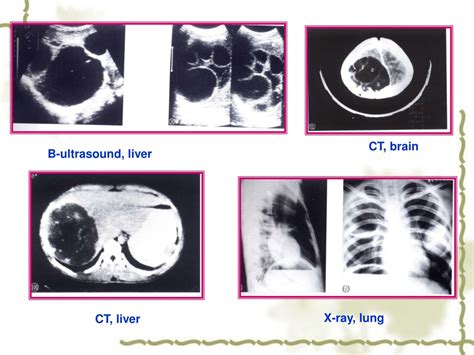 Ppt Echinococcus Granulosus 细粒棘球绦虫 Powerpoint Presentation Id9681899