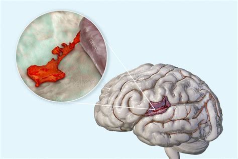 Arterial Bleed Stock Illustrations 24 Arterial Bleed Stock