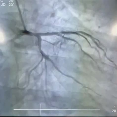 Shaik Masood Mohiddin On Linkedin Lmca Lad Provisional Stenting Lm Pot Was Done At Aster