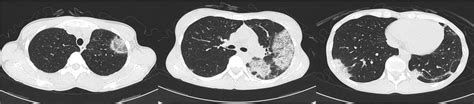 Chest Computed Tomography Showing Multiple Bilateral Peripheral Patchy