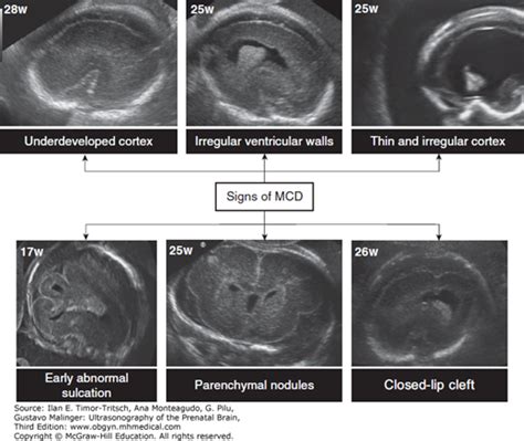 Macrocephaly Ultrasound