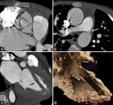 Left Ventricular False Tendons Unseen Or Overlooked Case Reports In Clinical Radiology