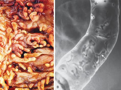 Ulcerative And Granulomatous Colitis Idiopathic Inflammatory Bowel Disease Clinical Tree