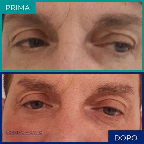 Filler Allacido Ialuronico Per Sollevare Gli Zigomi Chirurgia