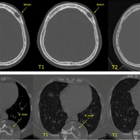 Evolution Of The Lytic Lesion During Follow Up In Patients With A Focal Download Scientific