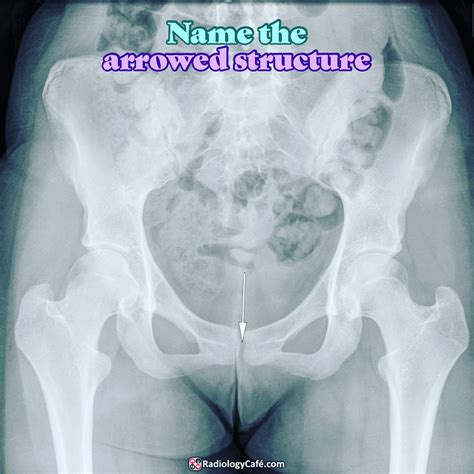 Radiology What Is This Structure 🤔 Post Your Answer In The Comments Well Post The Answer In