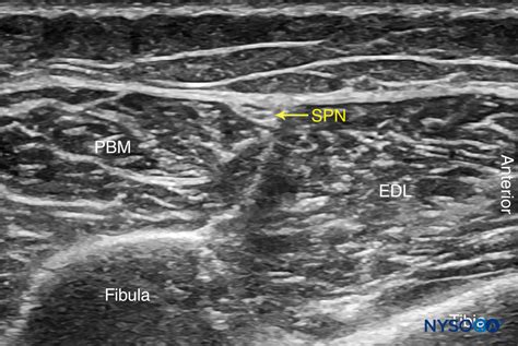 Regional Anesthesia Ultrasound Anatomy Of The Superficial Peroneal Nerve With Structures Labeled