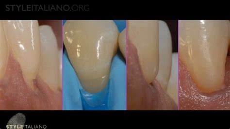 Isolation Of The Working Field In Class V Cavities