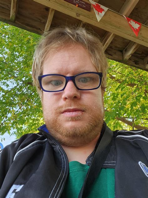 Jaw Surgery Pics Day 1 To 20 Rjawsurgery