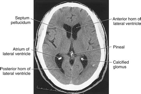 The Ventricles Choroid Plexus And Cerebrospinal Fluid Clinical Tree