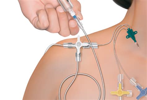 Lidcoplus Lidco Hemodynamic Monitoring For The Entire Patient Pathway