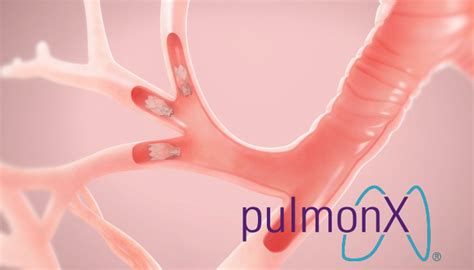 Pulmonx Wins Aetna Coverage For Zephyr Endobronchial Valve Massdevice