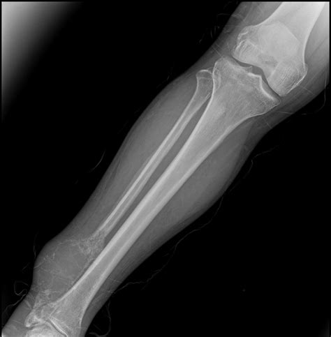 Osteosarcoma Radiology