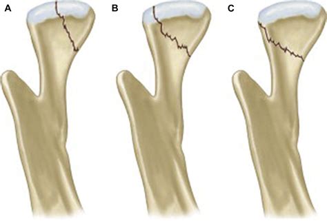 The Role Of Intra Articular Surgery In The Management Of Mandibular