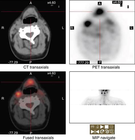 Occult Papillary Thyroid Carcinoma In Thyroglossal Cyst Diagnosed By