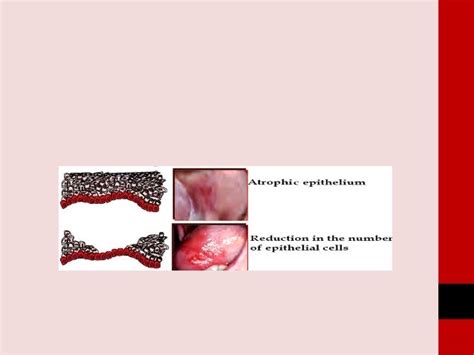 Red And White Lesions Of Oral Cavity