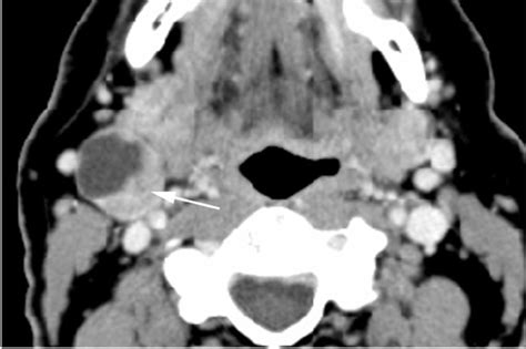 Cystic Neck Masses A Pictorial Review Of Unusual Presentations And