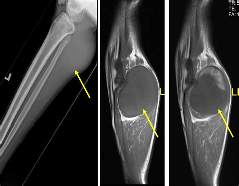 Malignant Peripheral Nerve Sheath Tumour Radiology Cases