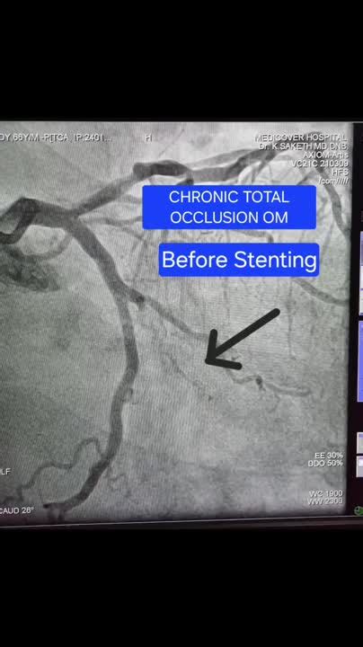 K Saketh Srivatsav On Linkedin Chronic Total Occlusion Cto Is A