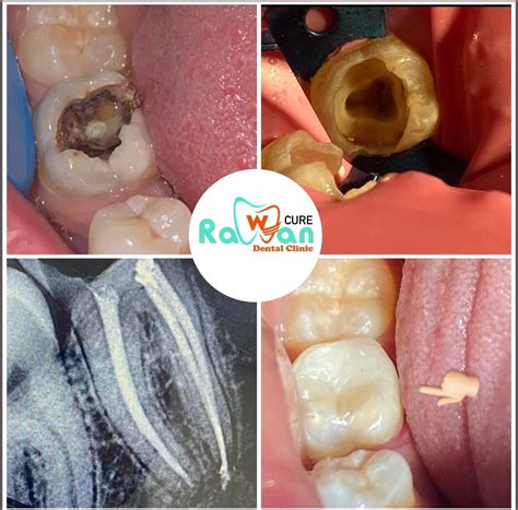 من الحالات الي تمت معالجتها بعيادة الروان كيور حشوة جذر للرحى السفلية ثم بناء السن بحشوة سيراميك