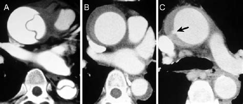 Various Types Of Aortic Dissection A Classic Dissection B Download Scientific Diagram