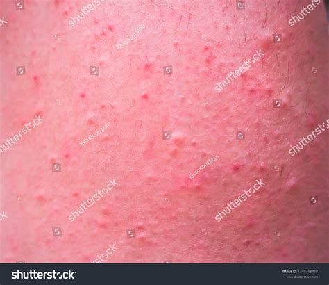 Skin Itching Rashred Spots On Skinred 스톡 사진 1349748710 Shutterstock